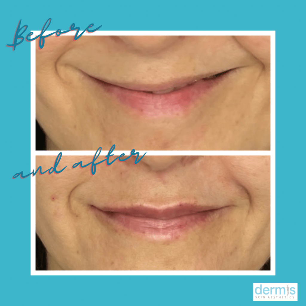 Kiss and Tell: Unmasking the Potential Risks of Lip Fillers – Dermis ...