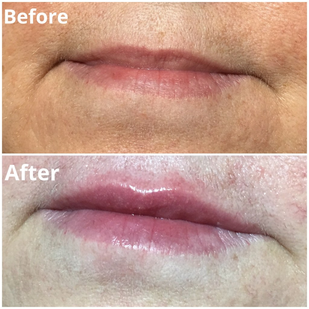 Kiss and Tell: Unmasking the Potential Risks of Lip Fillers – Dermis ...
