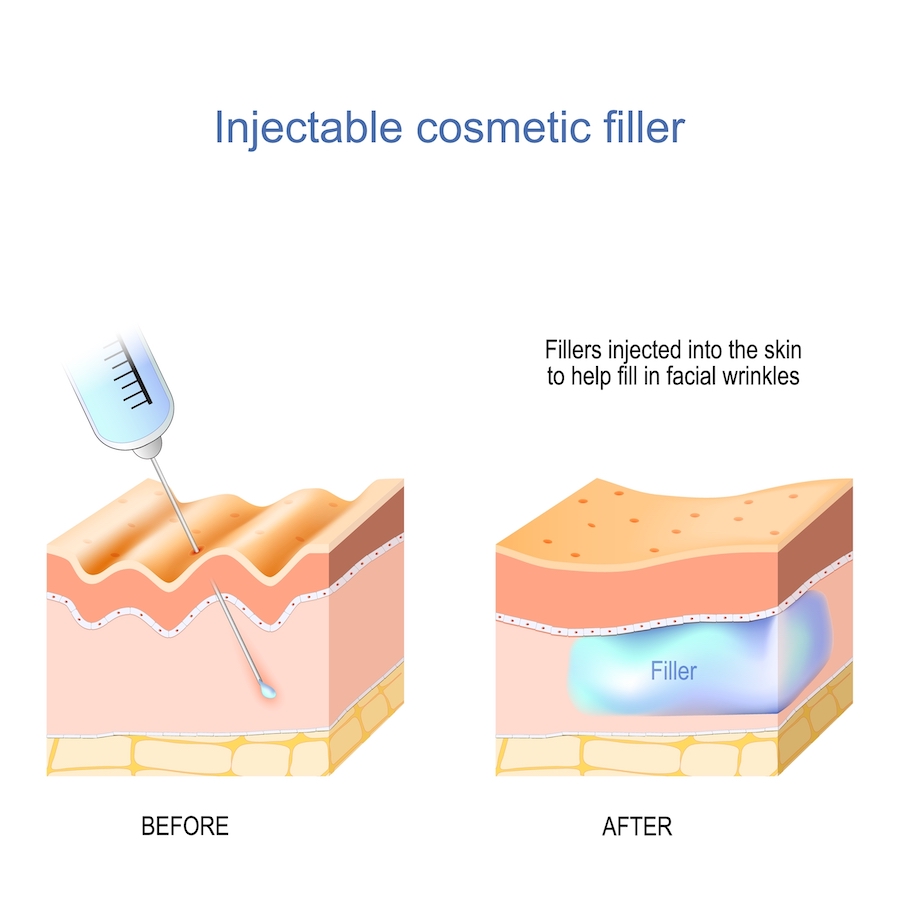 Everything You Never Kne You Needed to Know About Dermal Fillers ...